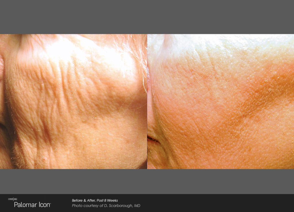 ICON Laser Resurfacing - Photorejuvenation - Rodin Clinic
