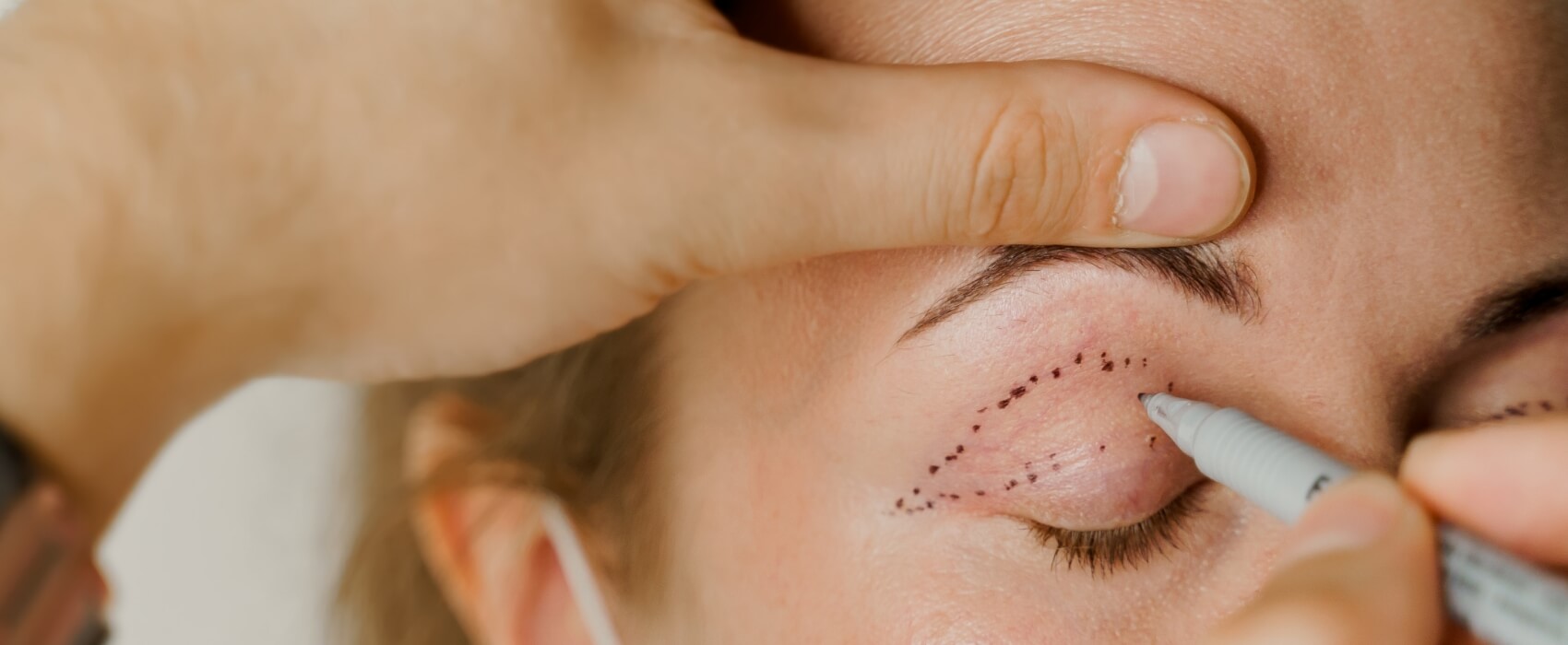 Blepharoplasty Perth - Eyelid Surgery WA - Rodin Clinic